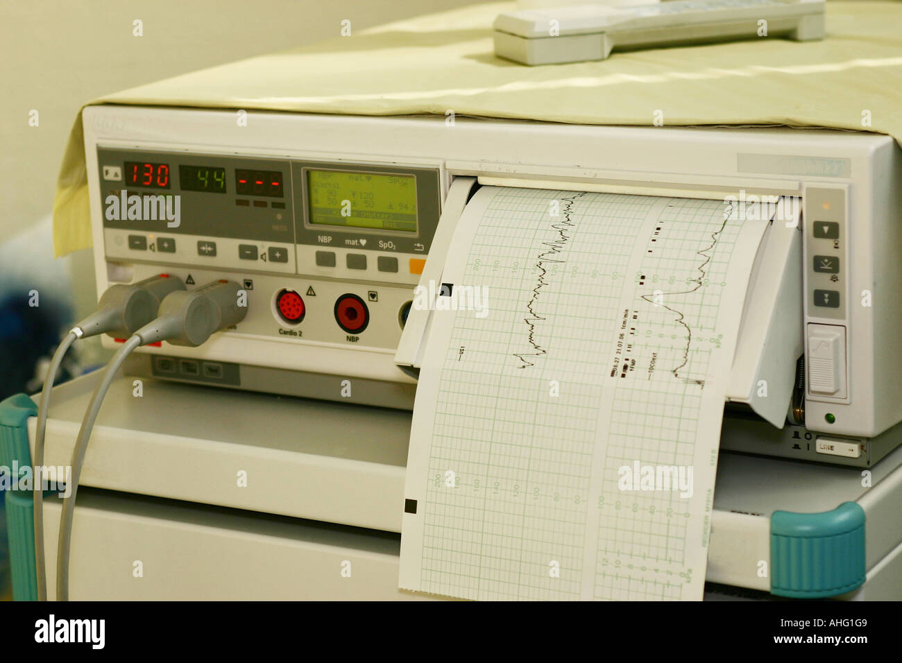 cardiotocograph, CTG, heart sound chart of an unborn child and a ...