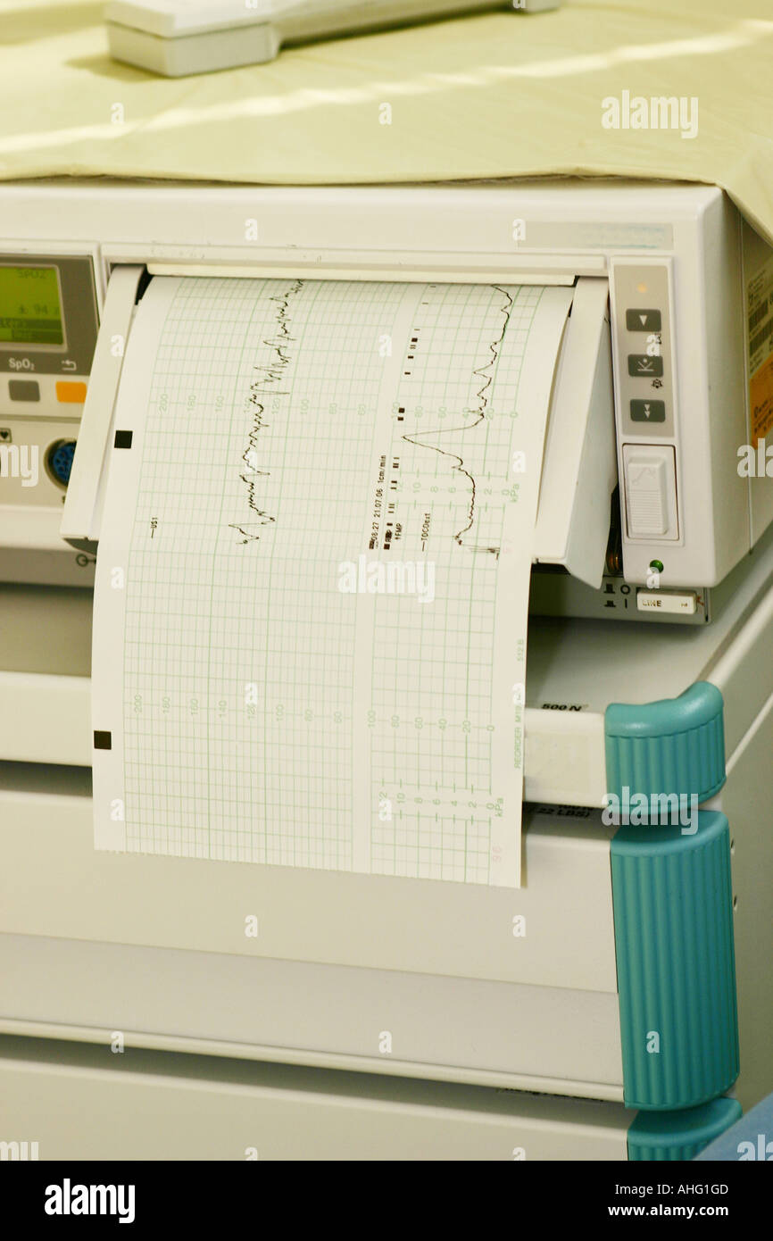 cardiotocograph, CTG, heart sound chart of an unborn child and a ...