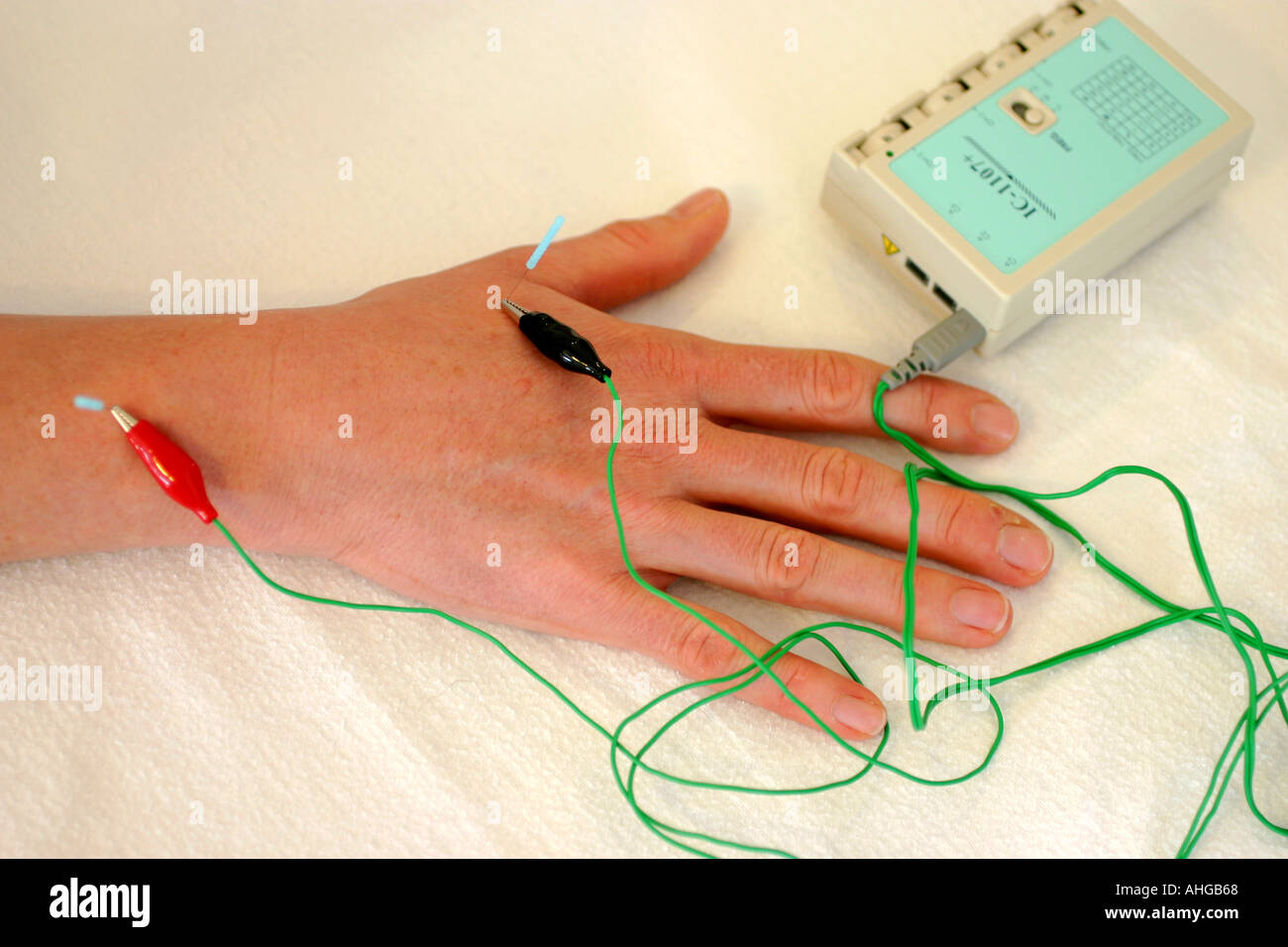 acupuncture on hand with electricity Stock Photo - Alamy