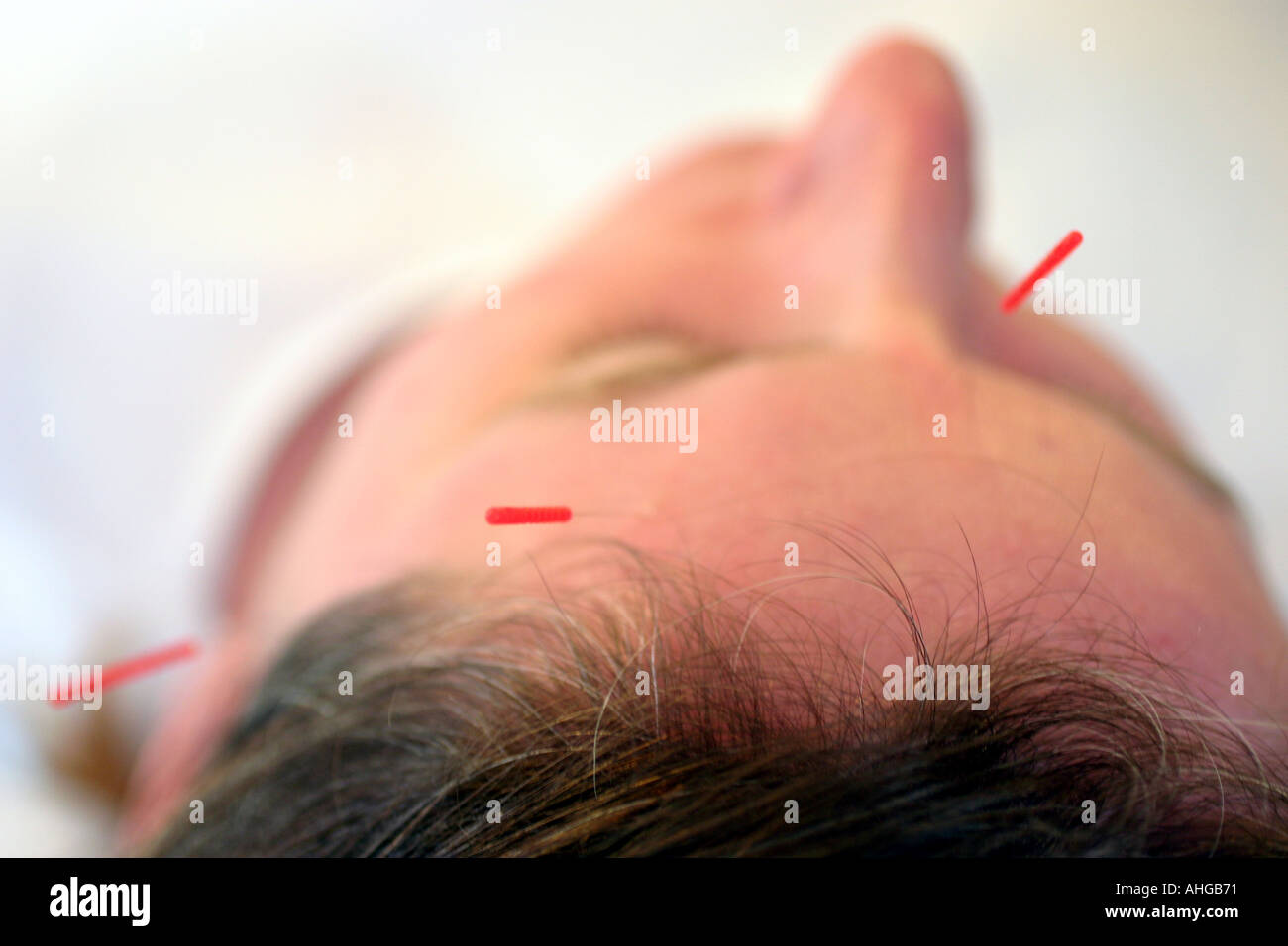 acupuncture treatment on forehead Stock Photo - Alamy