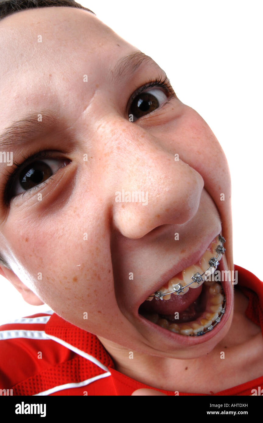 braces on young boy Stock Photo - Alamy