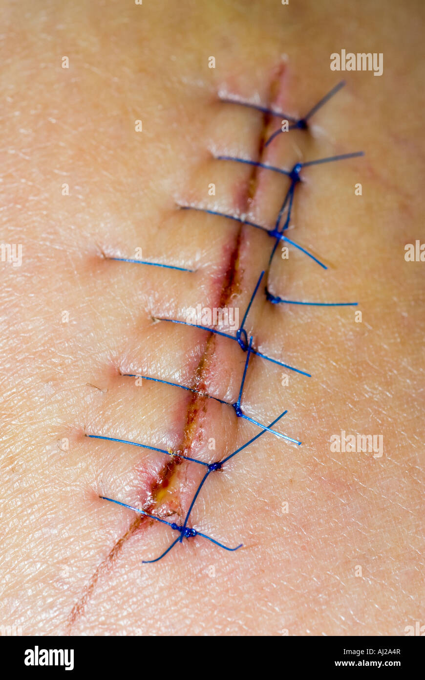 Stitches cut hi-res stock photography and images - Alamy