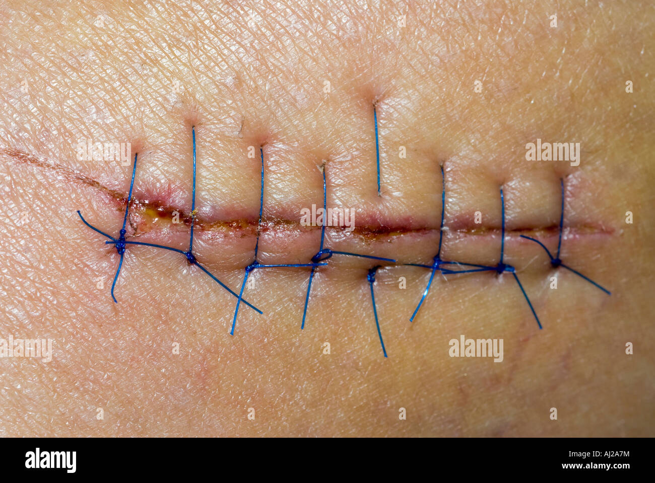 Stitches cut hi-res stock photography and images - Alamy