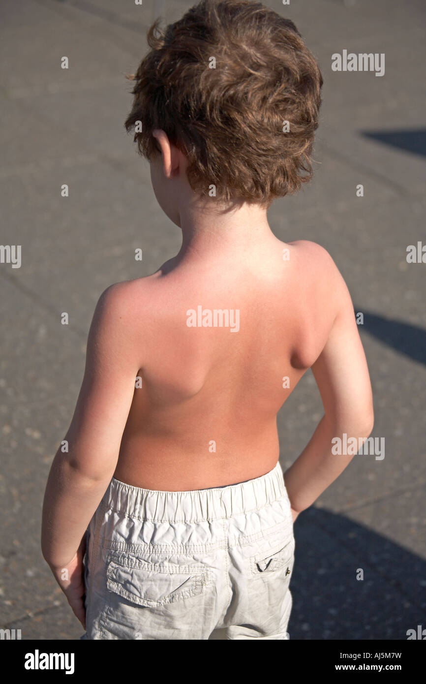 Sunburnt child hi-res stock photography and images - Alamy