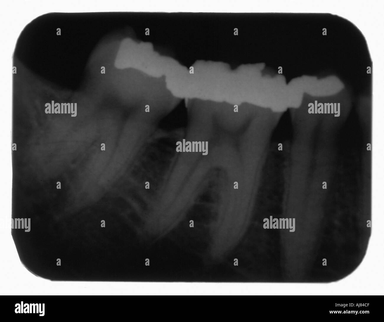 X ray of a cavity in a tooth Stock Photo - Alamy
