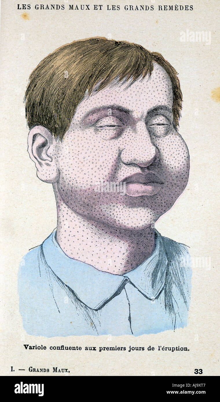 Smallpox 19th century hi-res stock photography and images - Alamy