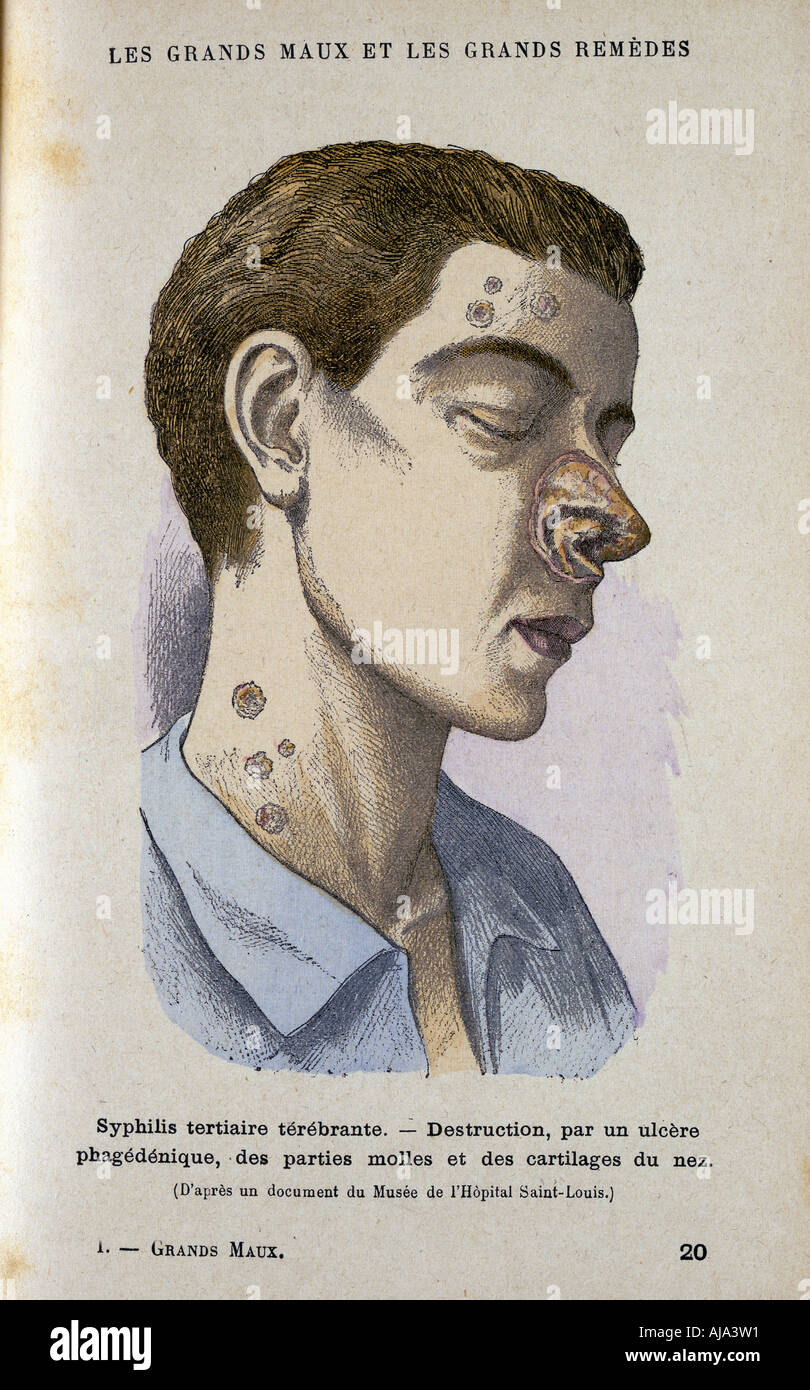Symptoms of the tertiary phase of syphilis, c19th century. Artist ...