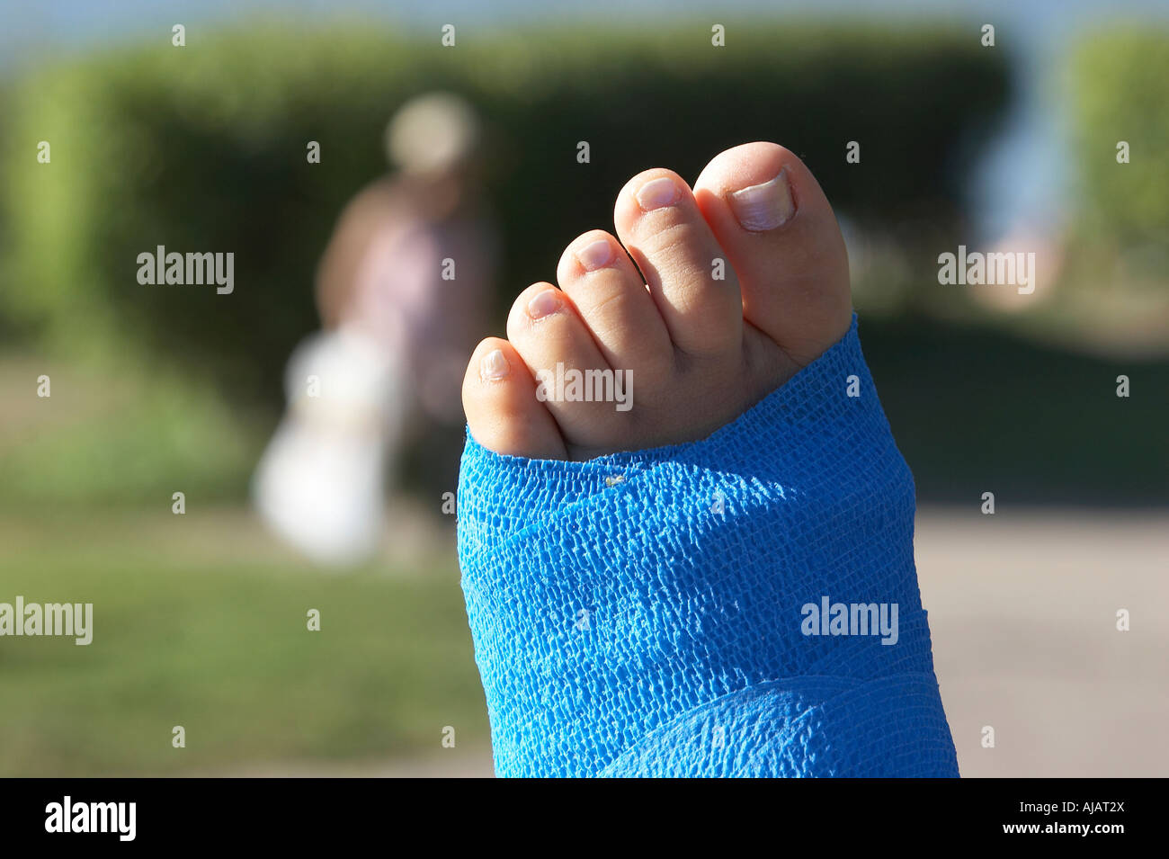 Broken foot. Temporary blue ace bandage cast for broken foot Stock ...