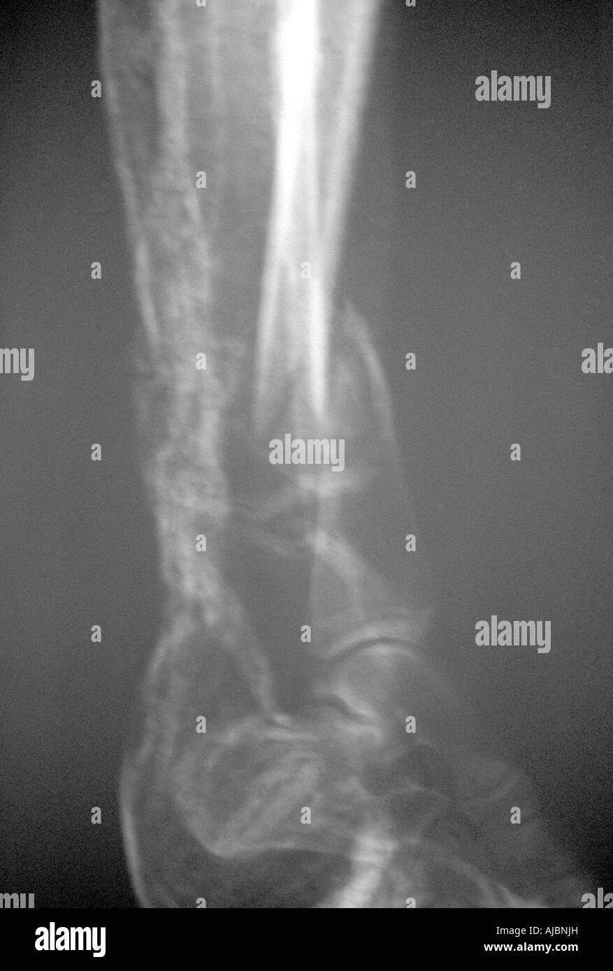 Low tibial fracture in a temporary plaster backslab Stock Photo - Alamy