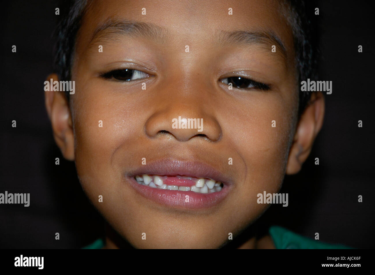 boy wisdom tooth Stock Photo - Alamy