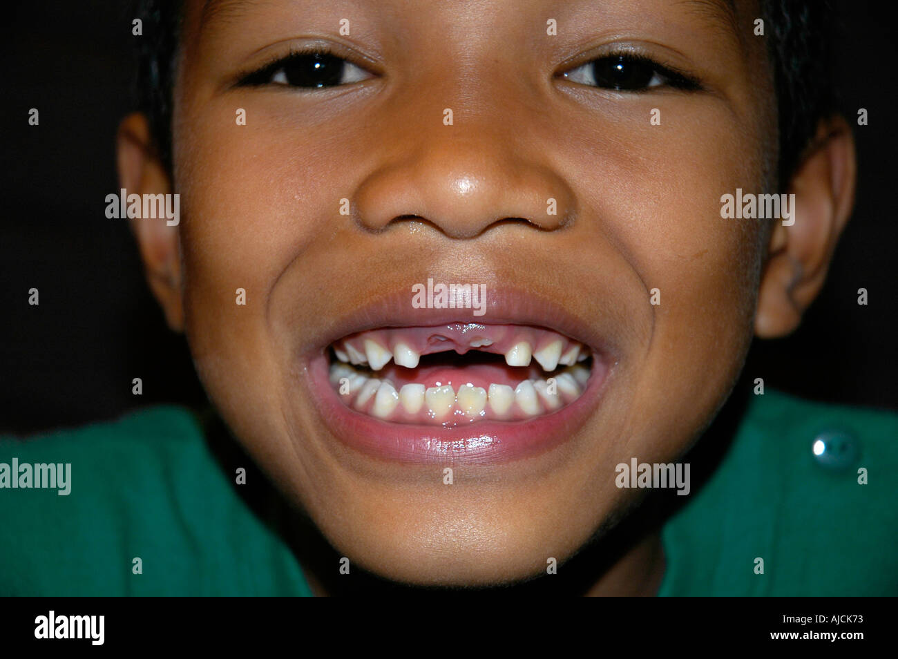 boy wisdom tooth Stock Photo - Alamy