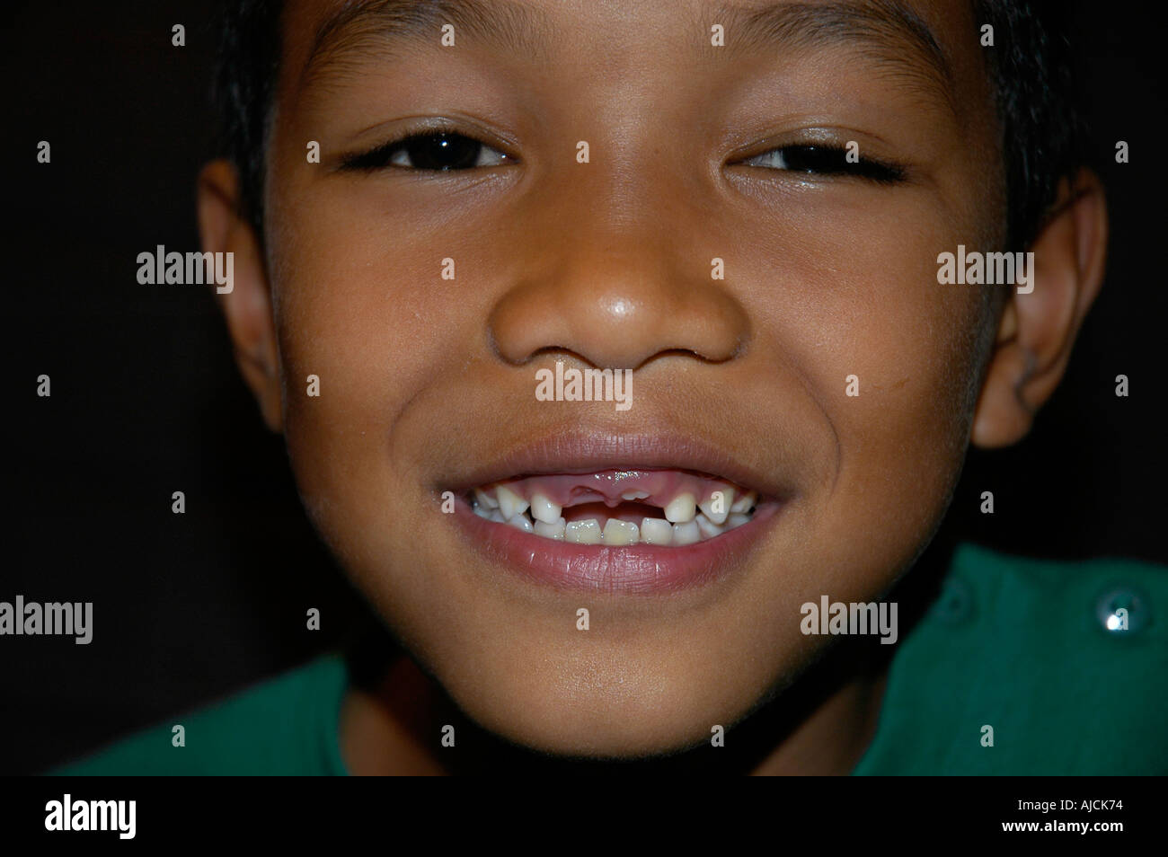 boy wisdom tooth Stock Photo - Alamy