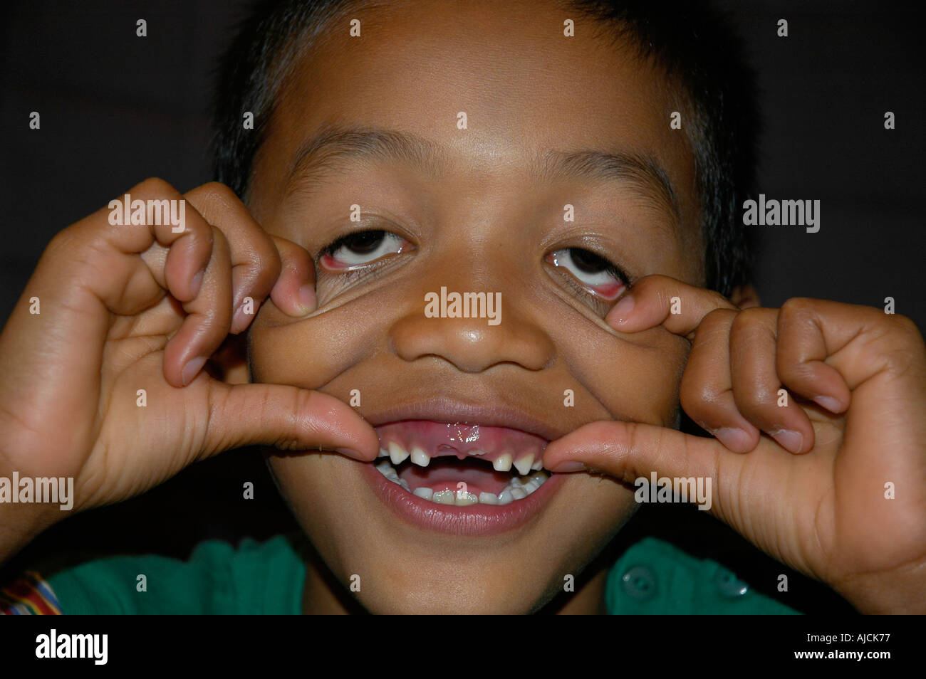 boy wisdom tooth Stock Photo - Alamy