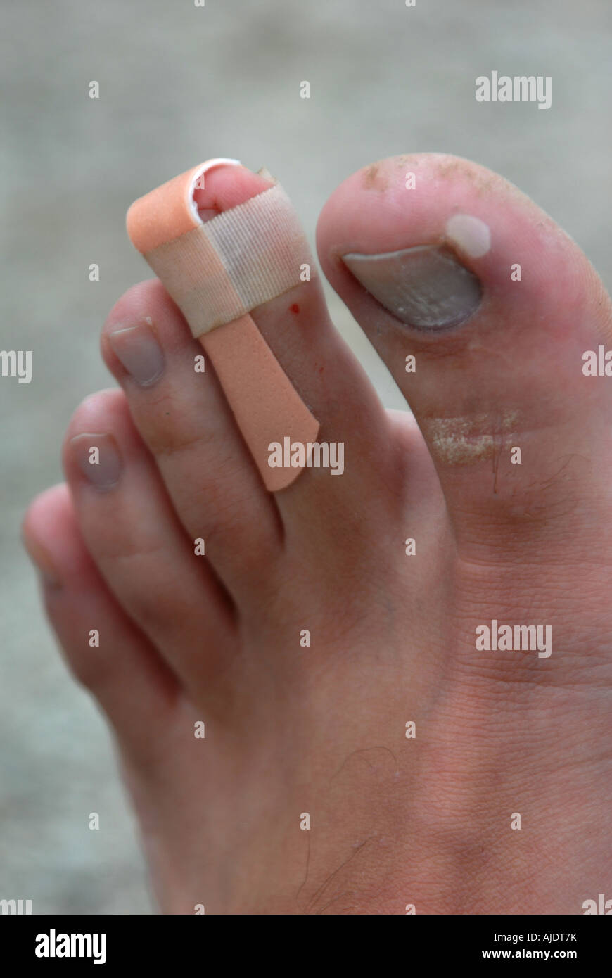 A bandanged toe is shown after a long day of hiking near Sorata ...