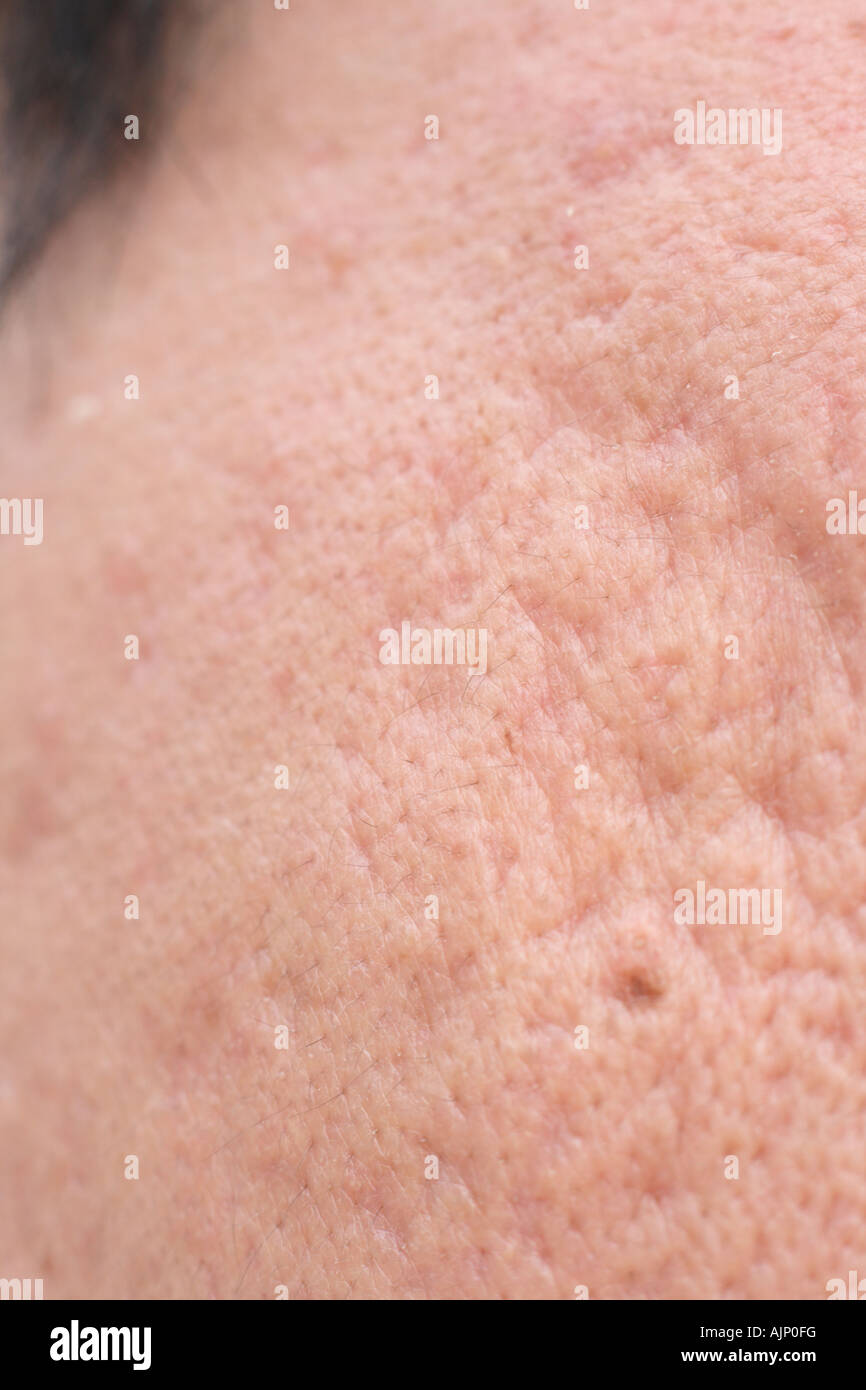 acne scarred face Stock Photo - Alamy