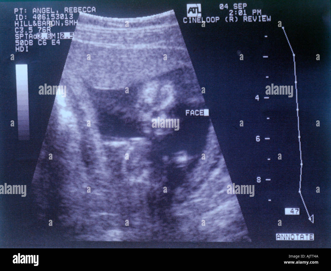 Four month ultrasound hi-res stock photography and images - Alamy