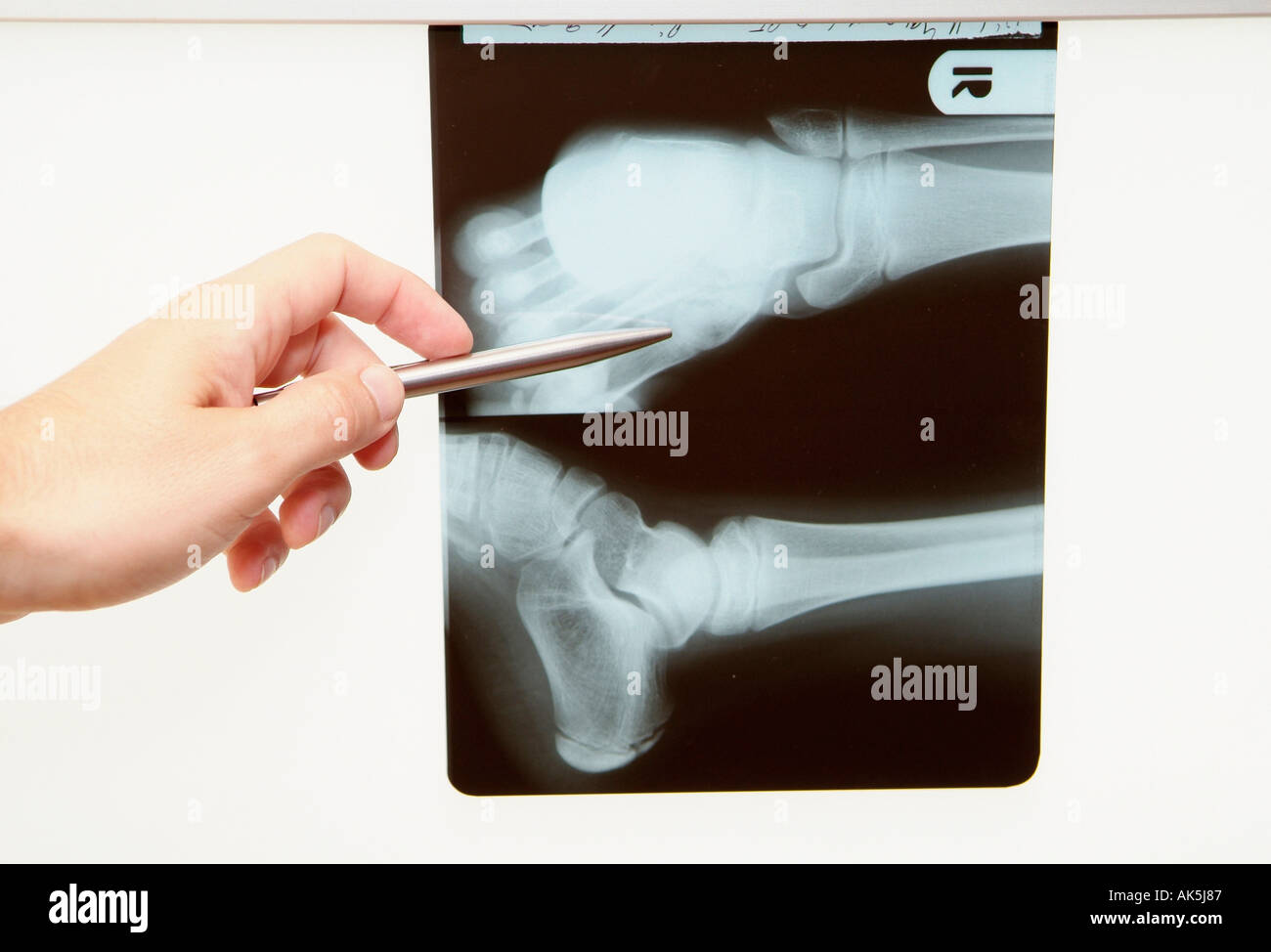Radiograph foot hi-res stock photography and images - Alamy