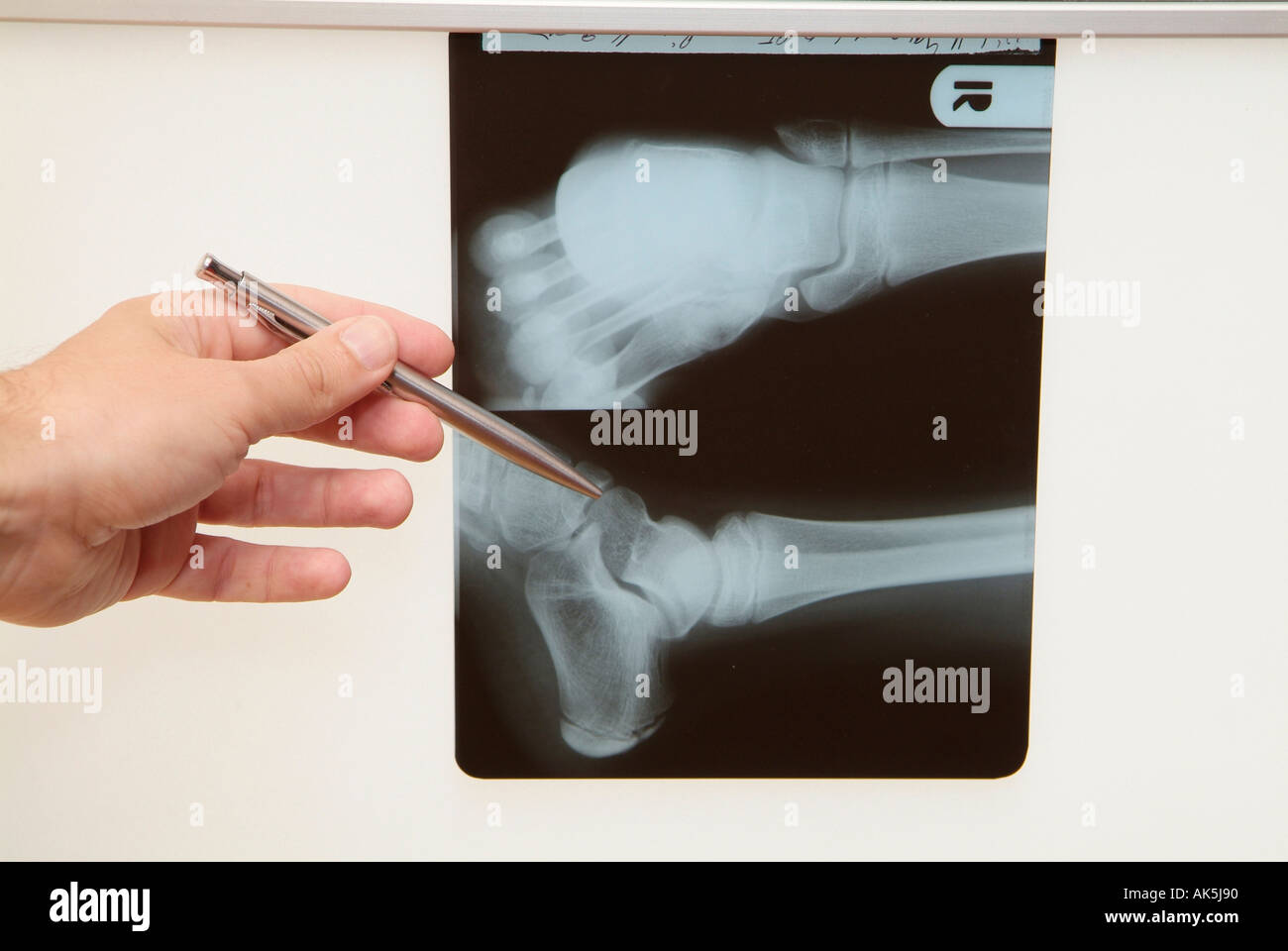 Radiograph foot hi-res stock photography and images - Alamy