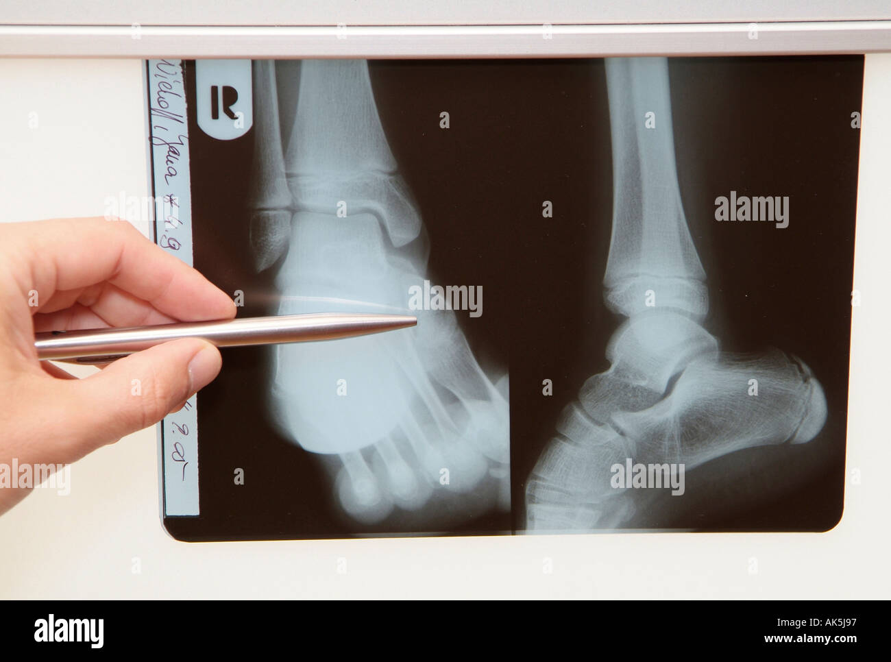 Radiograph Foot Stock Photos & Radiograph Foot Stock Images - Alamy