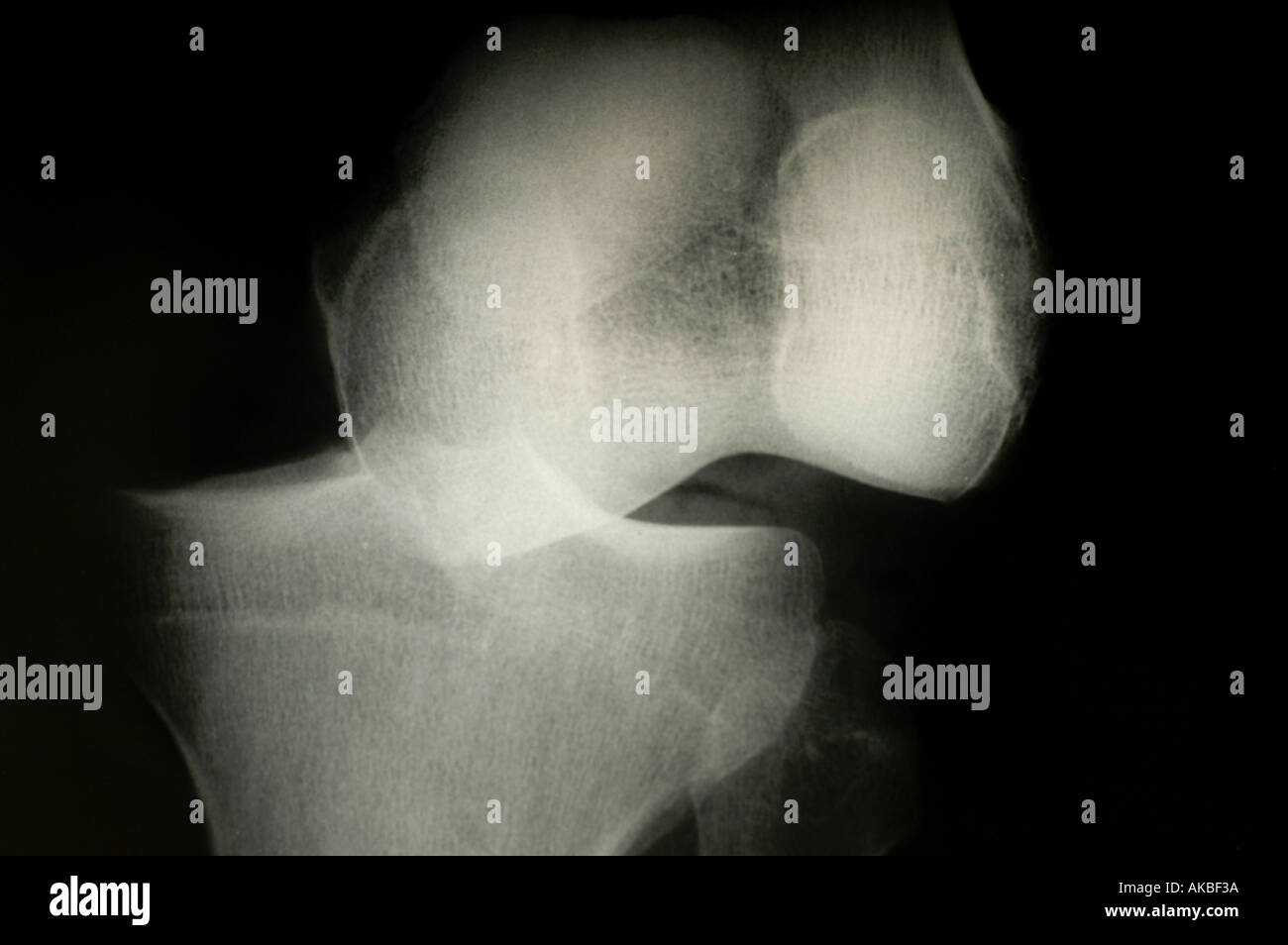 X-ray, bone dislocation after accident Stock Photo - Alamy