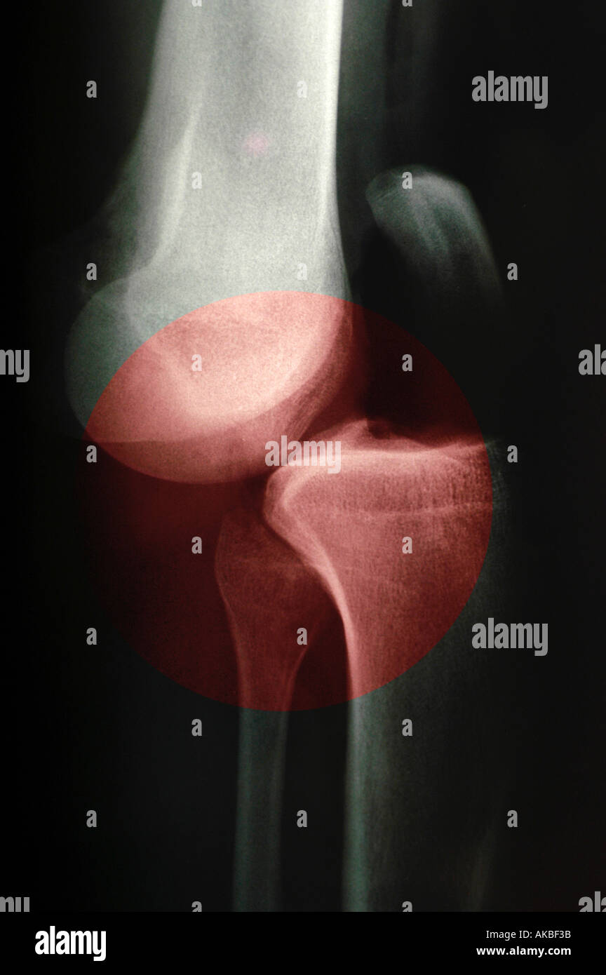 X-ray, bone dislocation after accident Stock Photo - Alamy