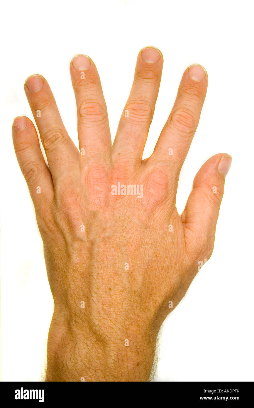 A stock photograph of a man's hand with six fingers Stock Photo - Alamy