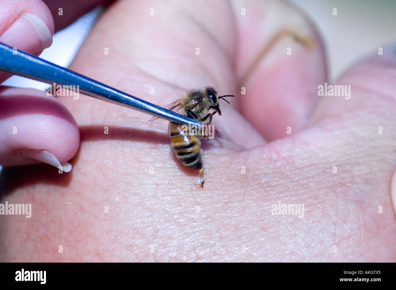 Bee venom therapy hi-res stock photography and images - Alamy