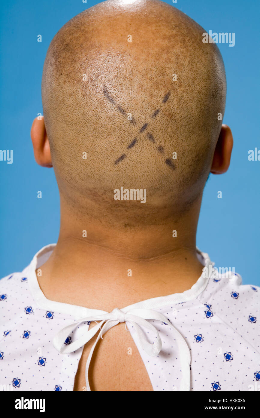 Male patient with X on head Stock Photo - Alamy