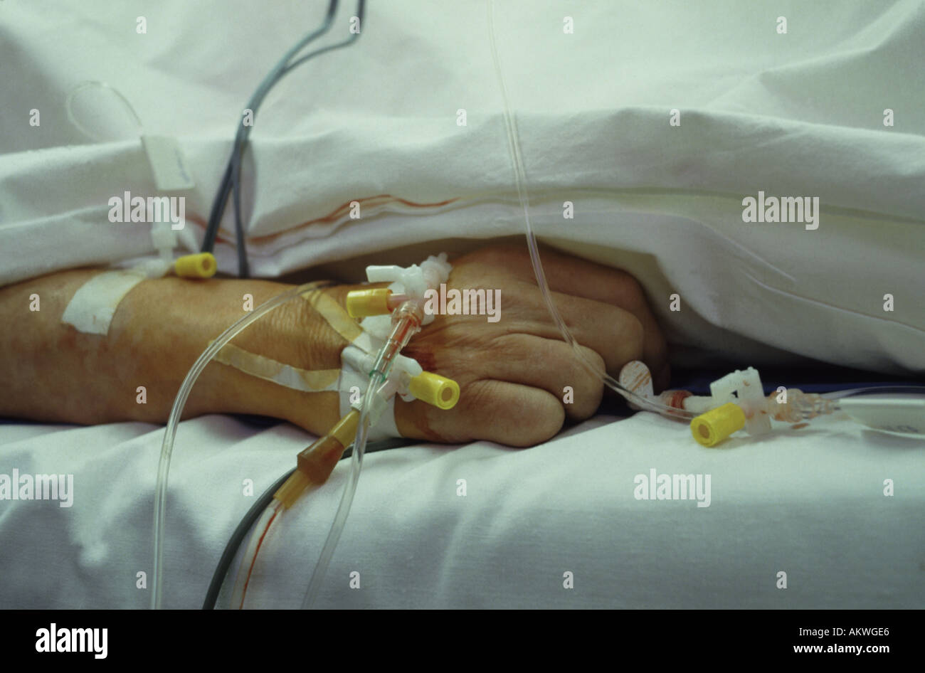 ICU, patient's hand with IV Stock Photo - Alamy