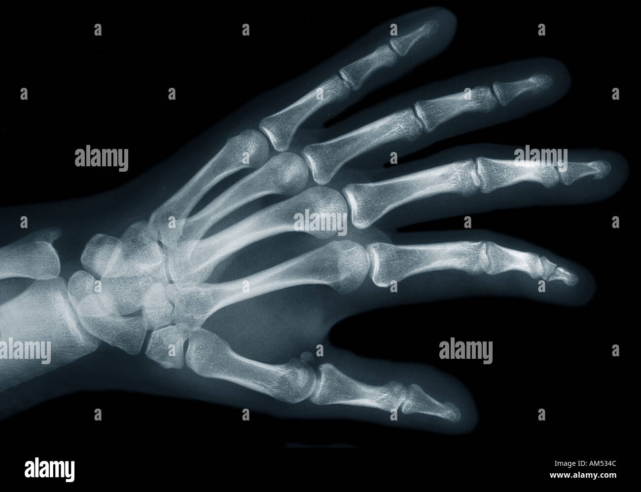 X ray of human hand Stock Photo - Alamy
