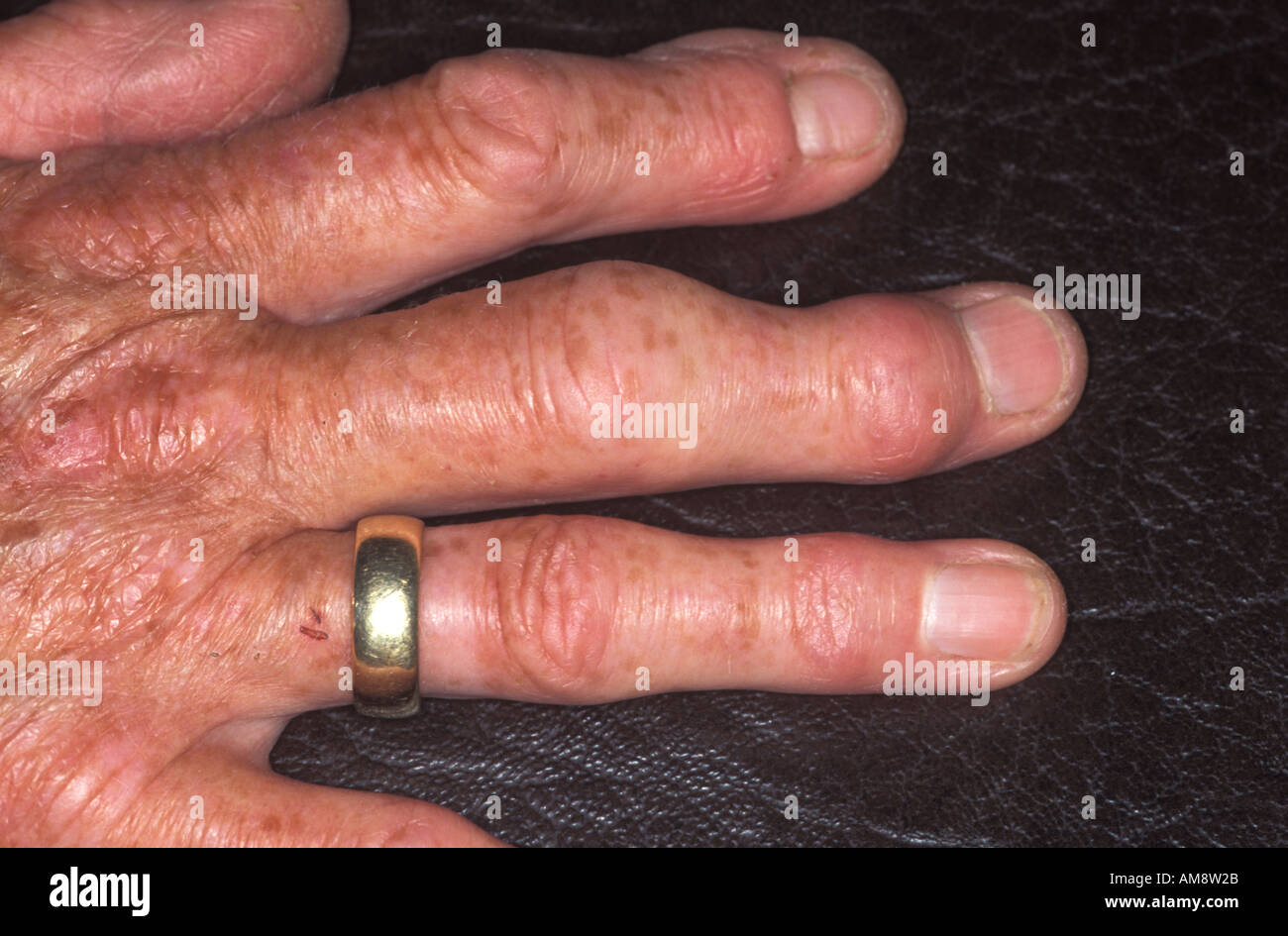 Heberdens Node High Resolution Stock Photography and Images - Alamy