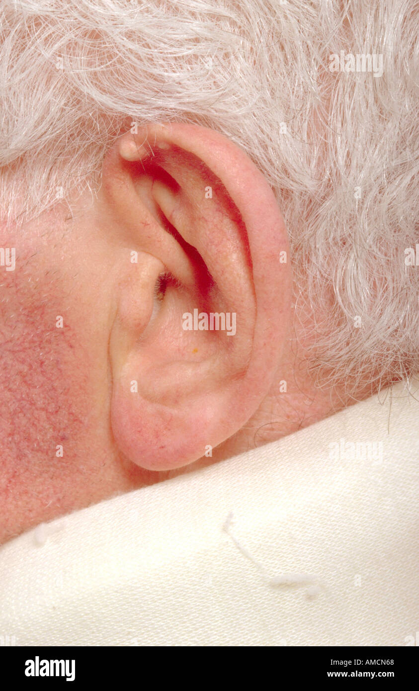 Tophus Ear