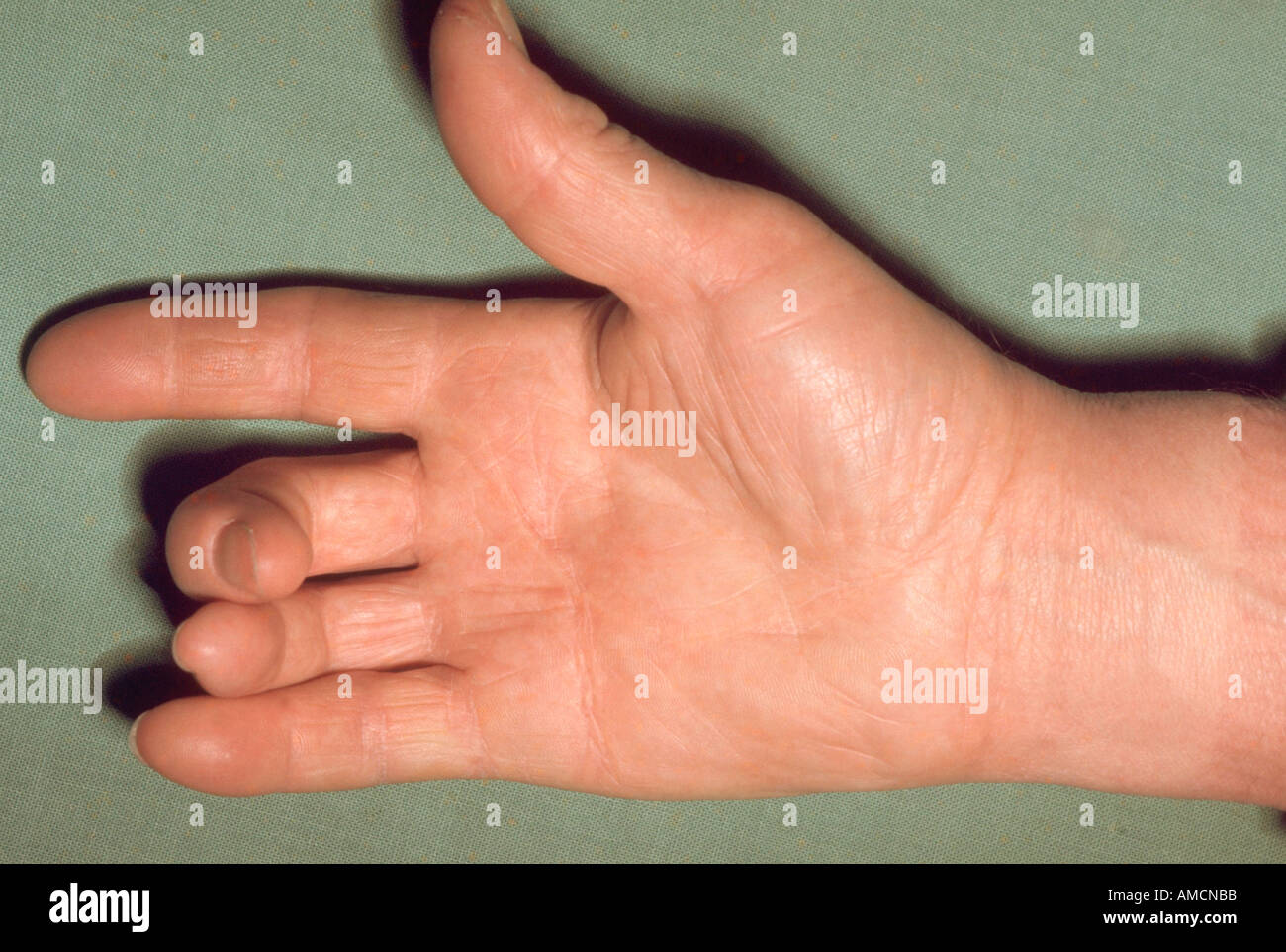 Dupuytrens contracture hi-res stock photography and images - Alamy