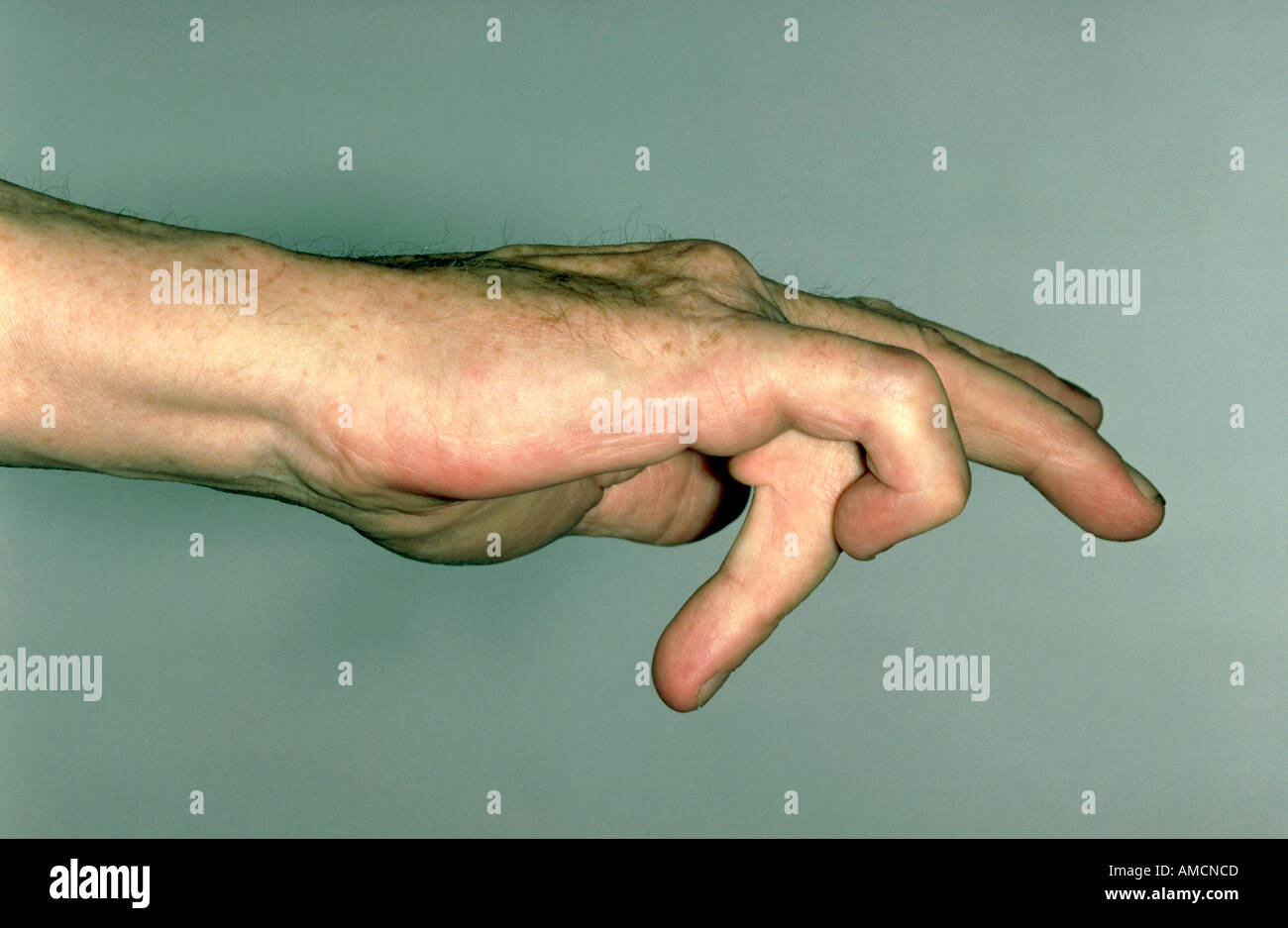 Dupuytrens contracture hi-res stock photography and images - Alamy