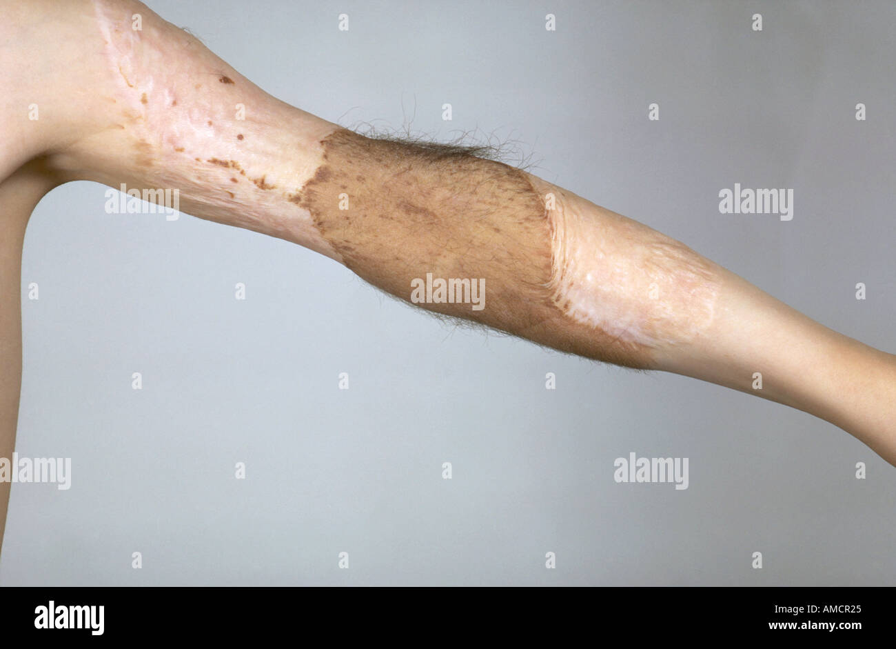 Pigmented naevus hi-res stock photography and images - Alamy