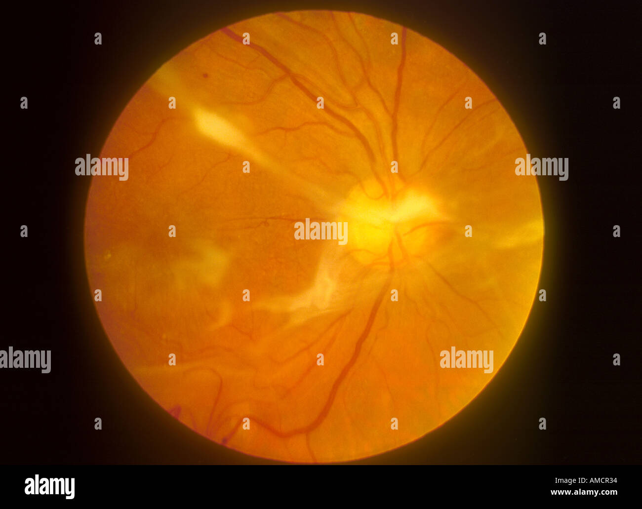 Diabetic retinopathy - optic disc Stock Photo - Alamy