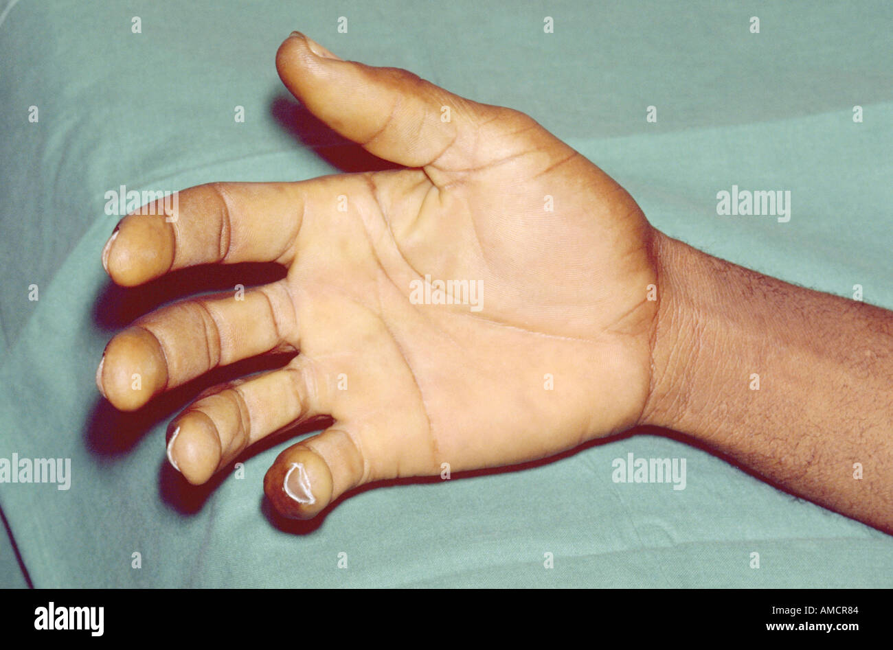 A photograph of a patient with ischaemia of the hand, cause by ...