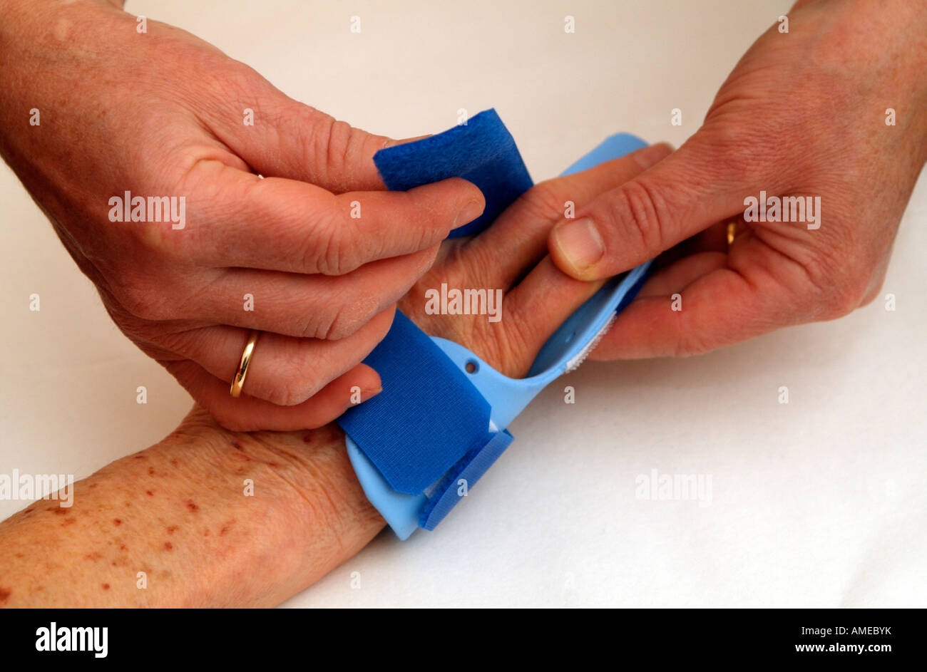 Dupuytrens Contracture Clinical Night Splint Fitting to Fingers and ...