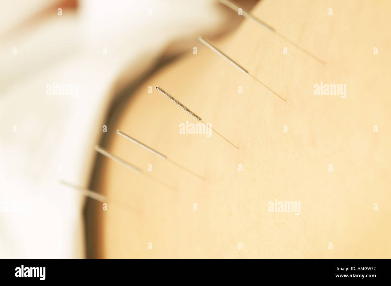 Applying acupuncture hi-res stock photography and images - Alamy