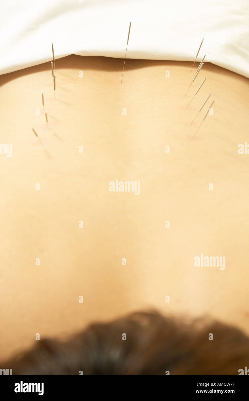 Applying acupuncture on skin Stock Photo - Alamy