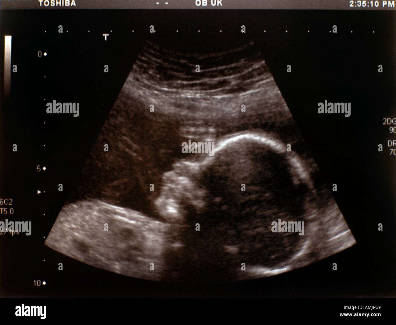 Ultrasound Scan of Four Month Old Foetus Stock Photo - Alamy