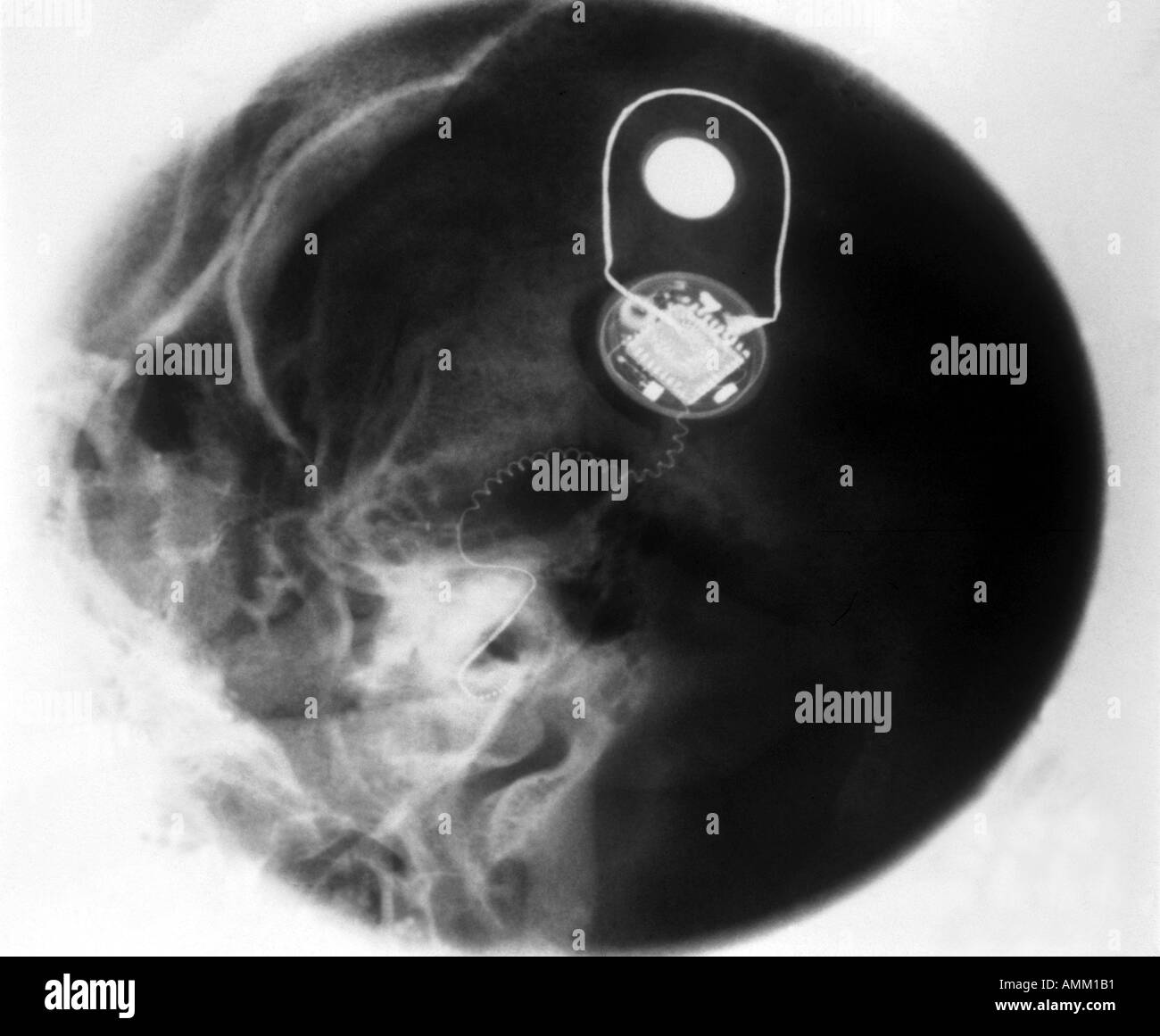 Cochlear implants hi-res stock photography and images - Alamy