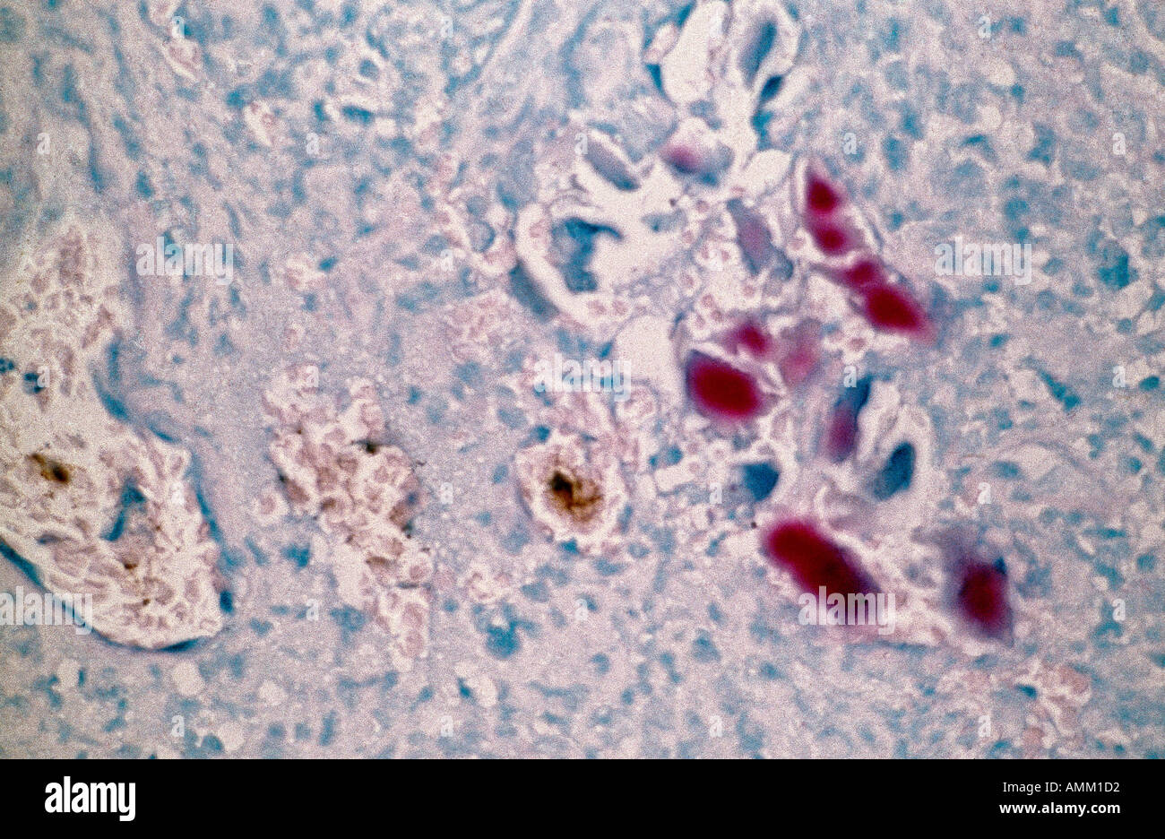 Photomicrograph conjunctival tuberculosis Stock Photo - Alamy