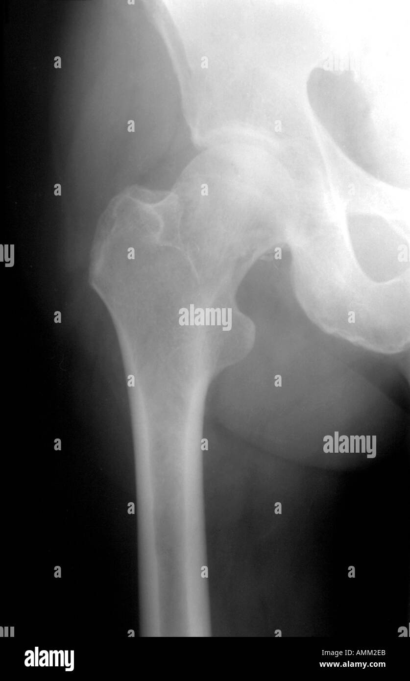 Femur neck fracture hi-res stock photography and images - Alamy