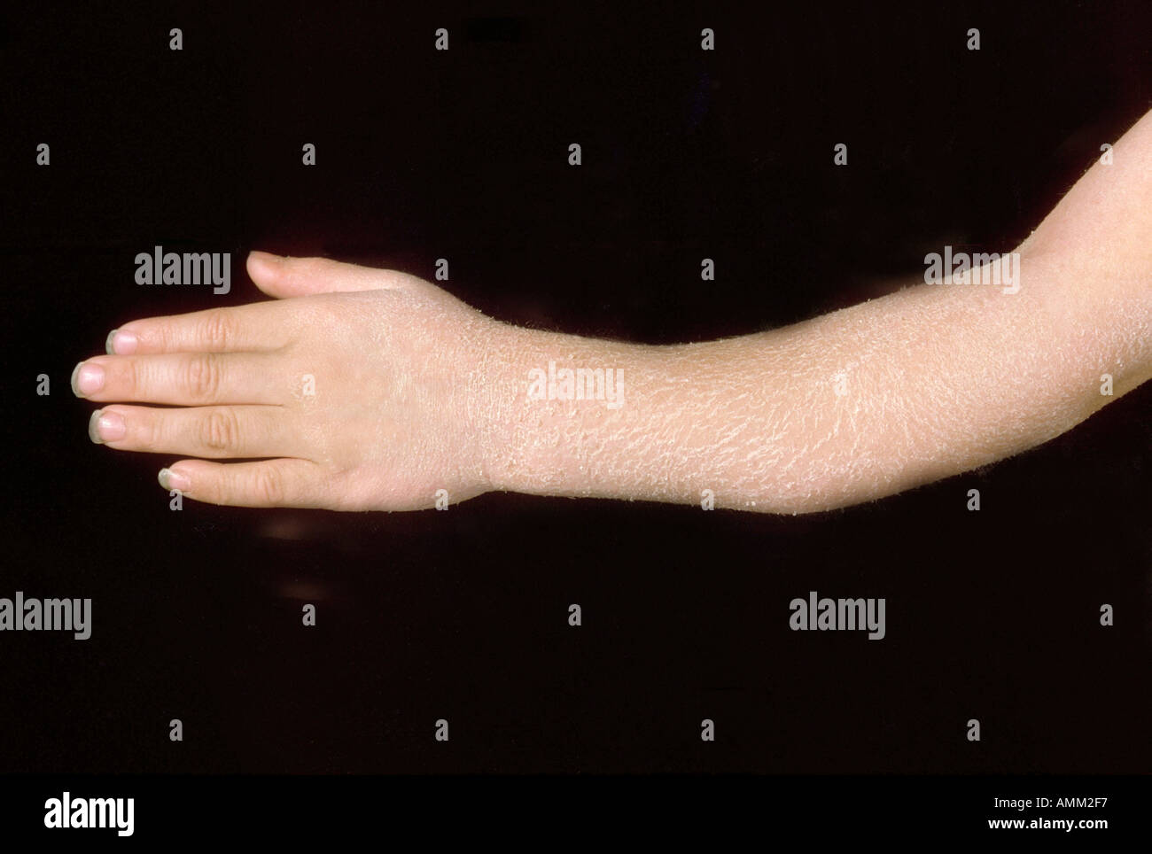 Fractured forearm hi-res stock photography and images - Alamy