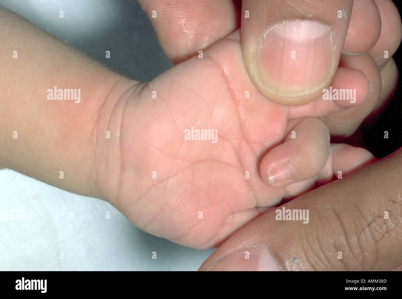 Simian Crease Down Syndrome Internet Scientific Publications