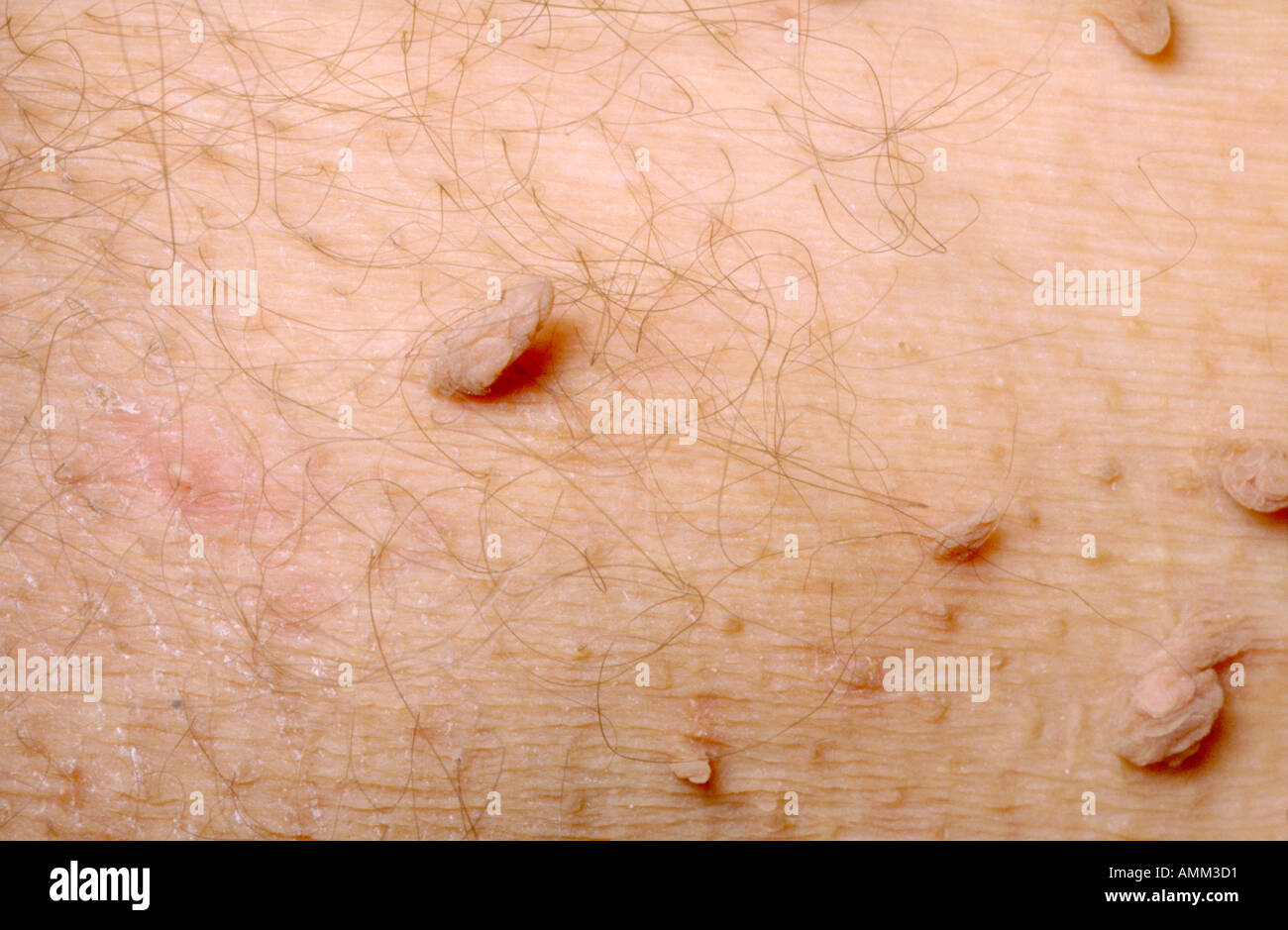 Multiple Skin Tags On Neck