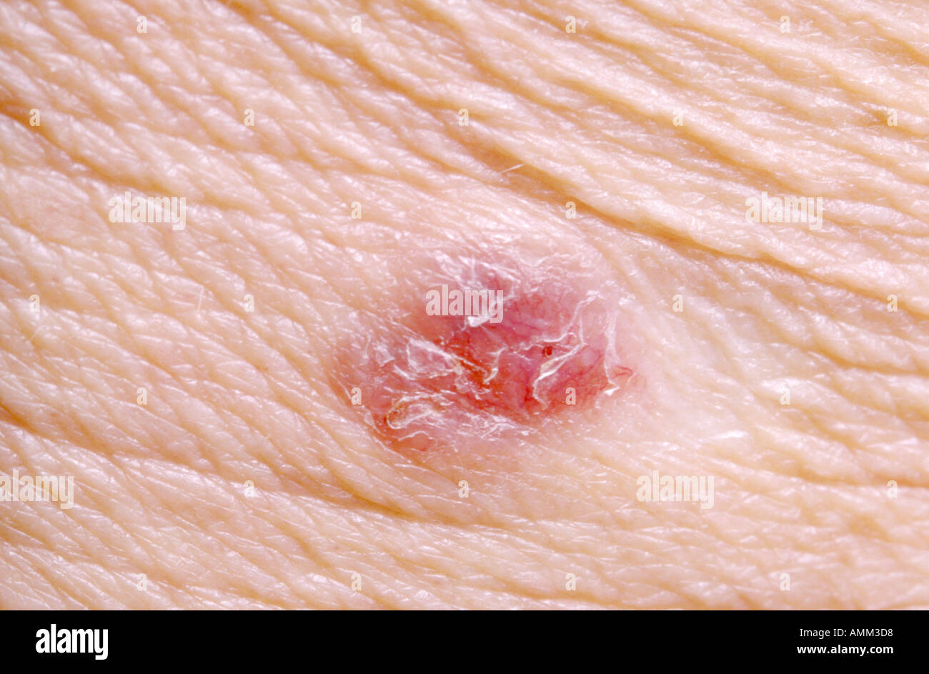 Rodent ulcer hi-res stock photography and images - Alamy