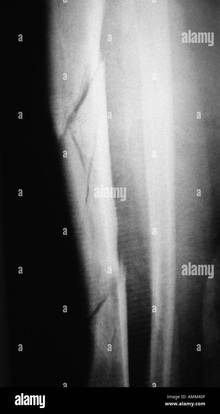 X ray comminuted tibial fracture Stock Photo - Alamy