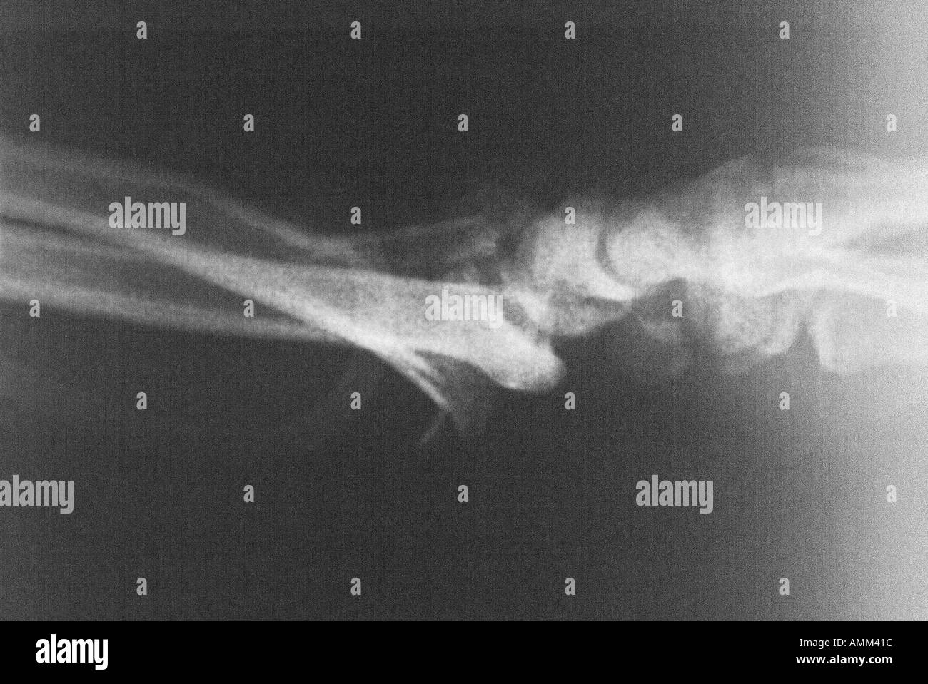 Distal radius fracture hi-res stock photography and images - Alamy